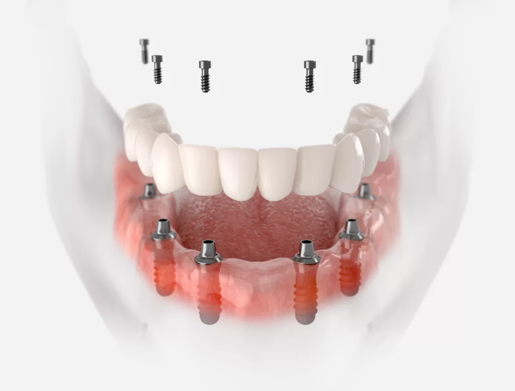 - All-On-6 Dental Implants at Fener Dental Clinic in Antalya - Fener ...